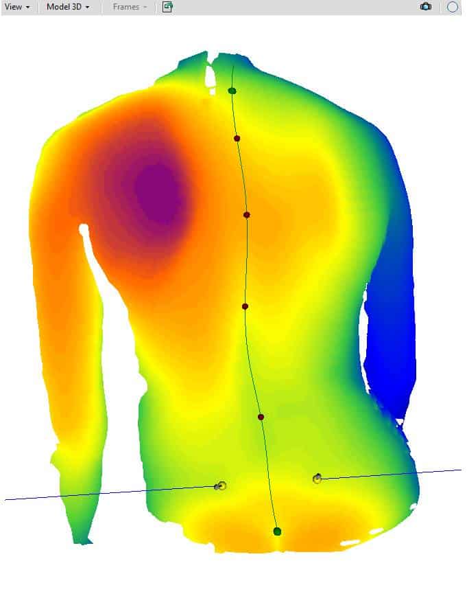 Surface Topography Imaging for Scoliosis and Posture - Align Therapy ...