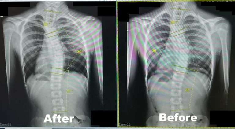 Schroth method before and after - Align Therapy Clinic in Lehi, Utah